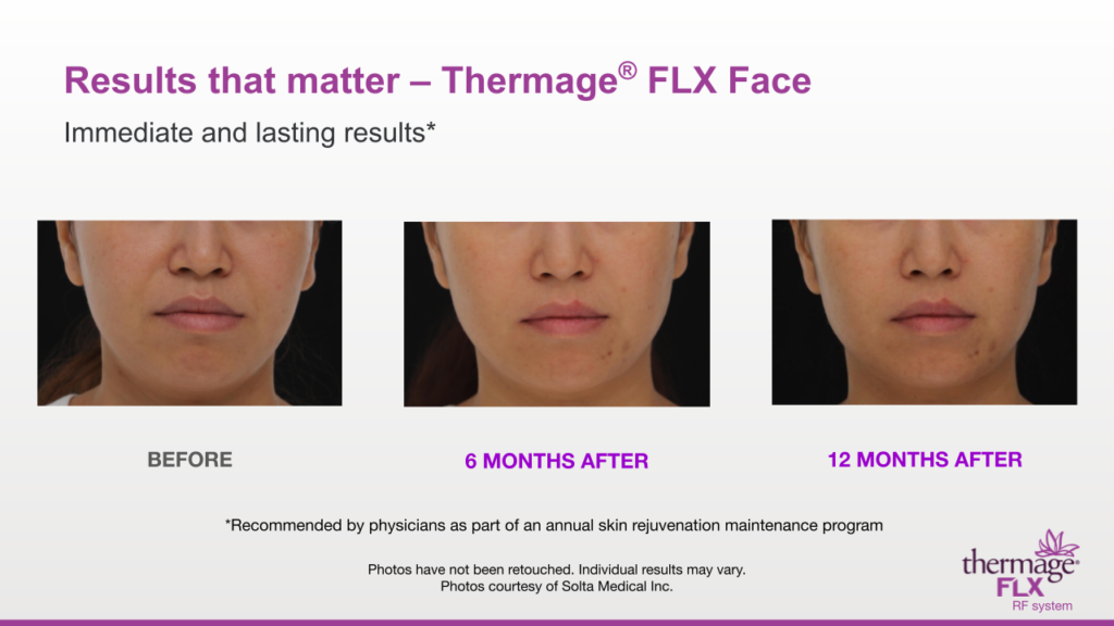 Thermage® – Profile Beauty Clinic
